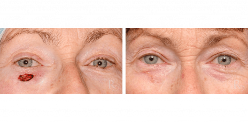 Before and After Cancer Surgery Transformations | Raymond Douglas