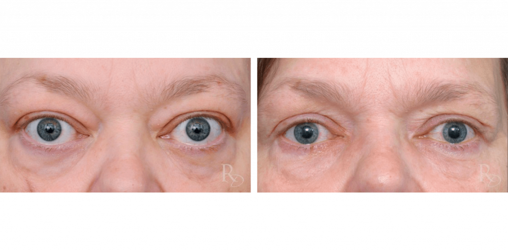 Thyroid Disease Before & After Transformations | Raymond Douglas