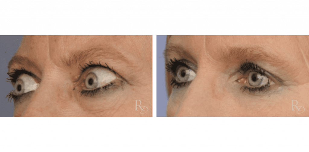 Eye Bulging Before & After Transformations | Raymond Douglas
