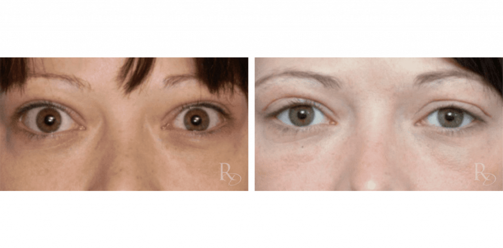 Eye Bulging Before & After Transformations | Raymond Douglas