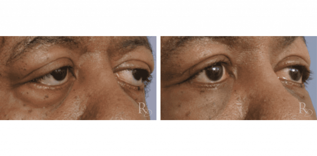 Eye Bulging Before & After Transformations | Raymond Douglas
