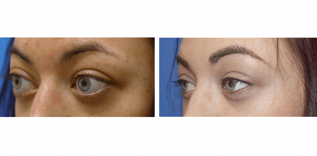 Before and After Decompression - Raymond Douglas