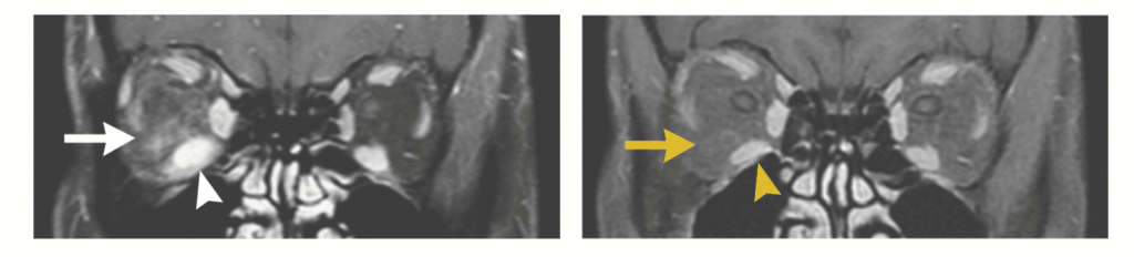 Thyroid Eye Disease Before and After Photos | Raymond Douglas