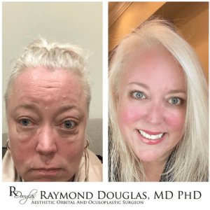 Conquer Eye Bulging with Tepezza Treatment | Raymond Douglas