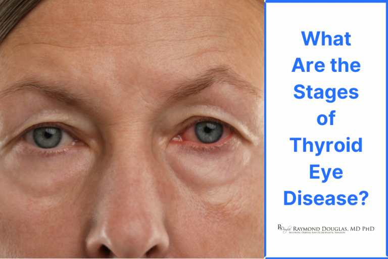 What Are the Stages of Thyroid Eye Disease? | Raymond Douglas