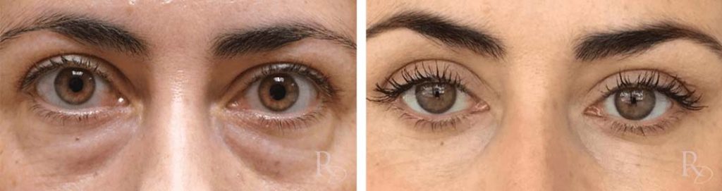 Eye Bulging Before & After Transformations | Raymond Douglas