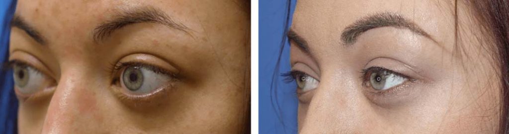 Orbital Decompression Before and After Photos | Raymond Douglas