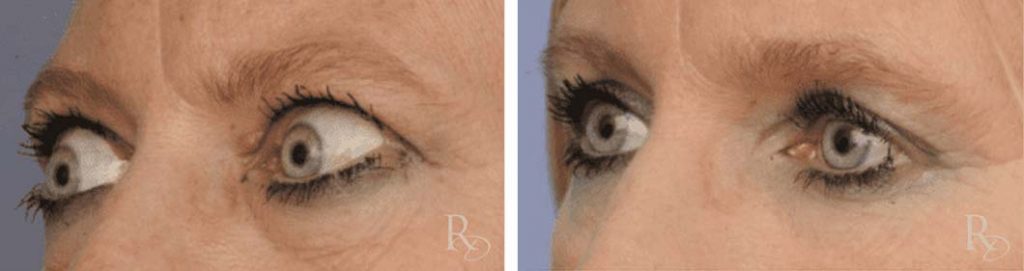Eye Bulging Before & After Transformations | Raymond Douglas