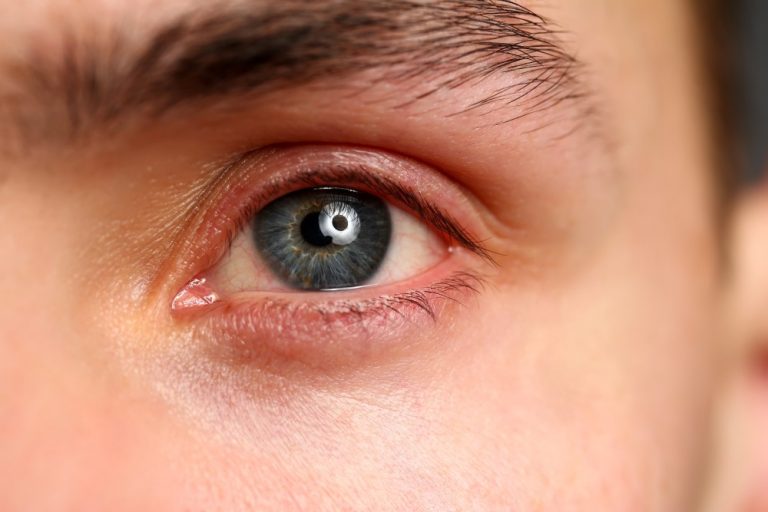 Bulging Veins on Eyelids and How to Treat Them